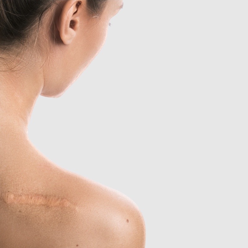 Scar Revision West Palm Beach, FL | Dr. Patrick Cleveland